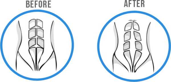 Core Strength & Diastasis Recti - Fitnotic